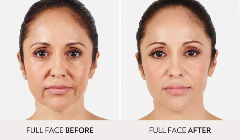 Fillers - Spa Radiance Medical