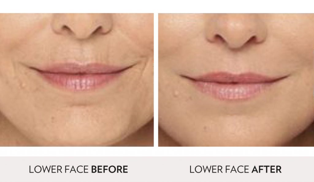 Fillers - Spa Radiance Medical