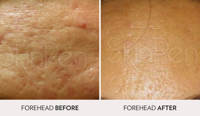 Microneedling and PRF - Spa Radiance Medical