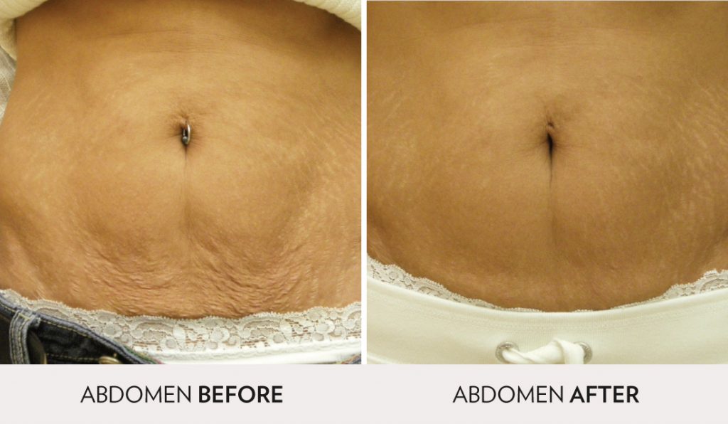 SkinTyte - Spa Radiance Medical