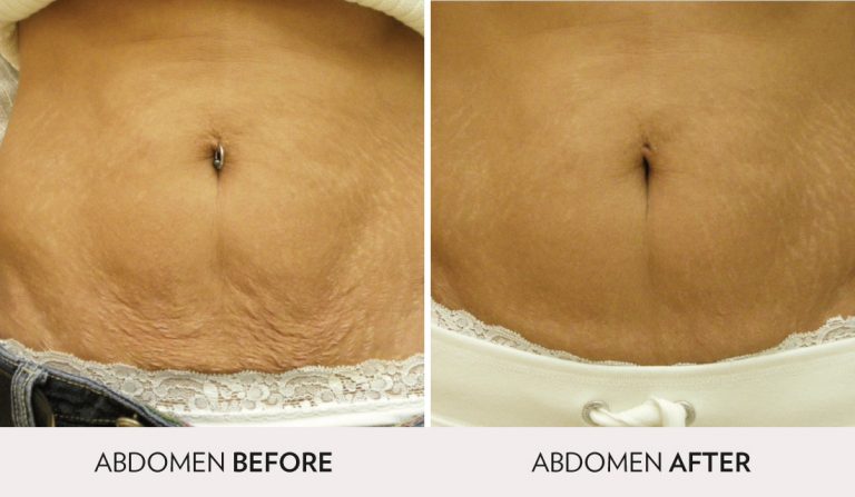 SkinTyte - Spa Radiance Medical