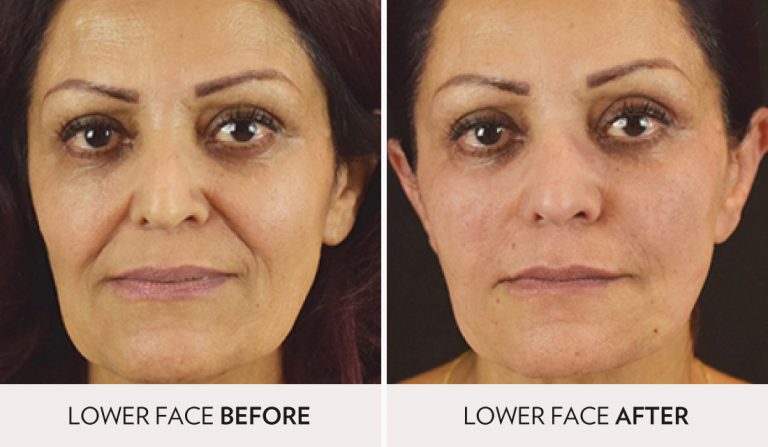 NovaThreads Face Lift - Spa Radiance Medical