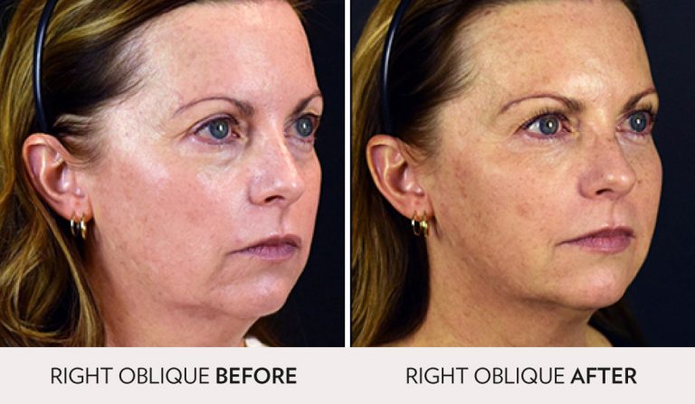 NovaThreads Face Lift - Spa Radiance Medical